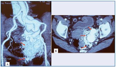 Congenital arteriovenous malformations: what are the perspectives ...