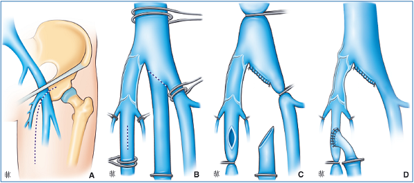 History of venous surgery (3) - Servier - PhlebolymphologyServier ...