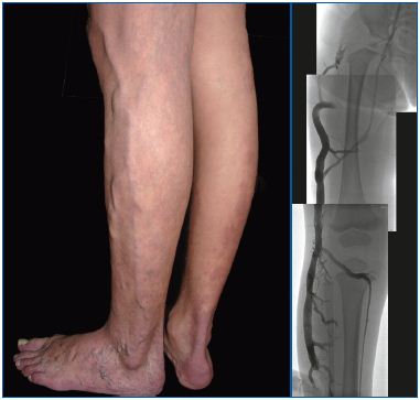 Venous embryology: the key to understanding anomalous venous conditions ...