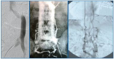 Venous embryology: the key to understanding anomalous venous conditions ...