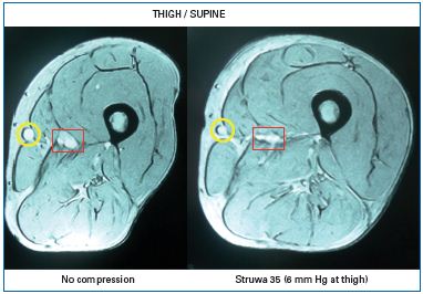 Critical Role of the Vasa Venarum in the Pathogenesis of Chronic Venous ...