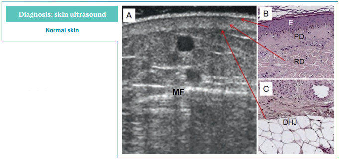 Management of hypodermitis or lipodermatosclerosis: an up-to-date ...