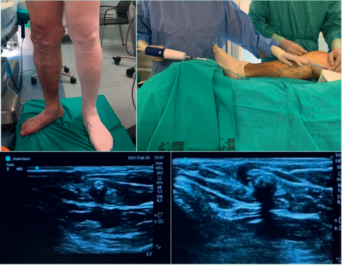 Management of hypodermitis or lipodermatosclerosis: an up-to-date ...