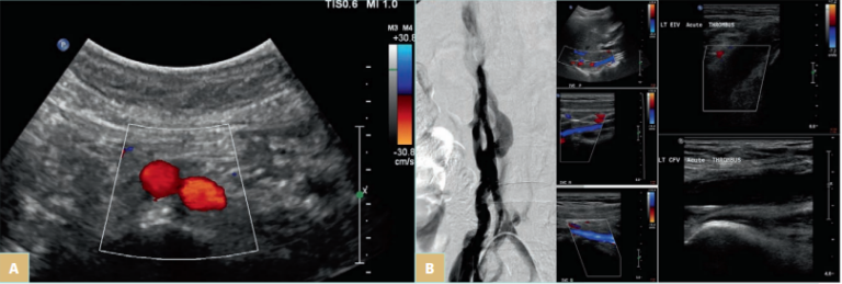 Overcoming the diagnostic challenges in deep venous obstruction: the ...